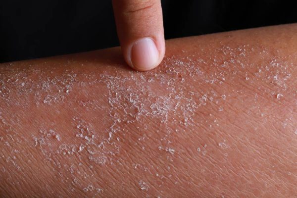 Dermatitis atópica: descubre cómo aliviarla y tratarla